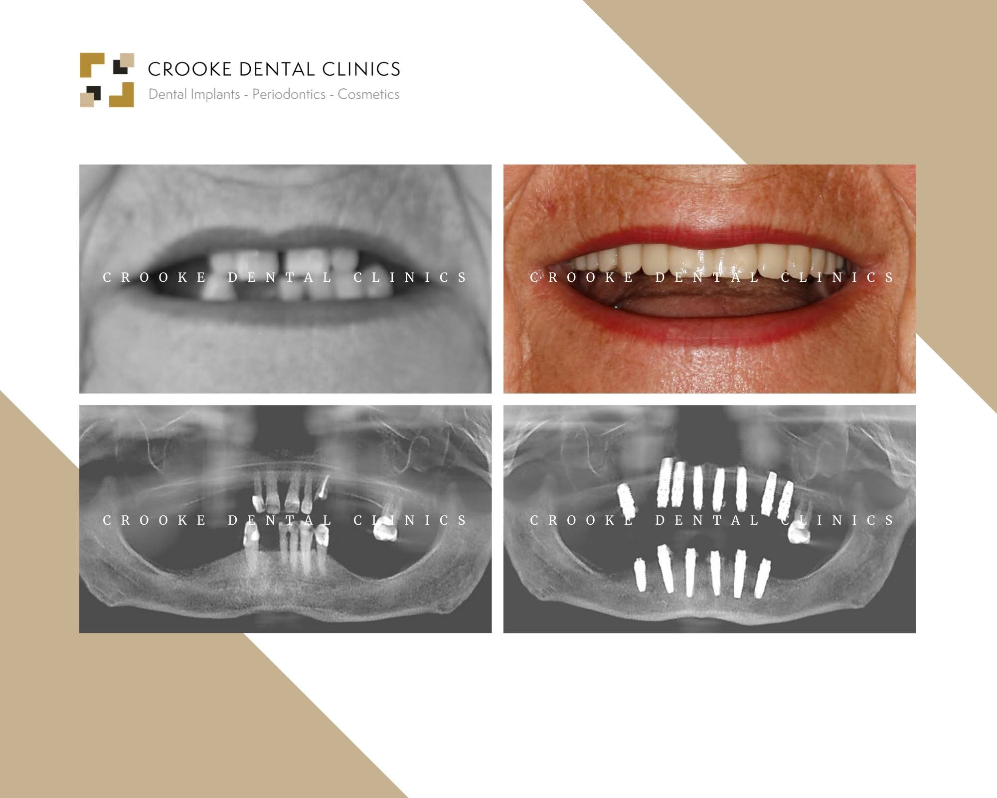 Implant rehabilitation with peek composite teeth - Dental Treatment In ...