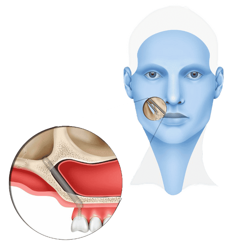 Dental Implants with Bone Loss | Zygomatic | Marbella-Gibraltar